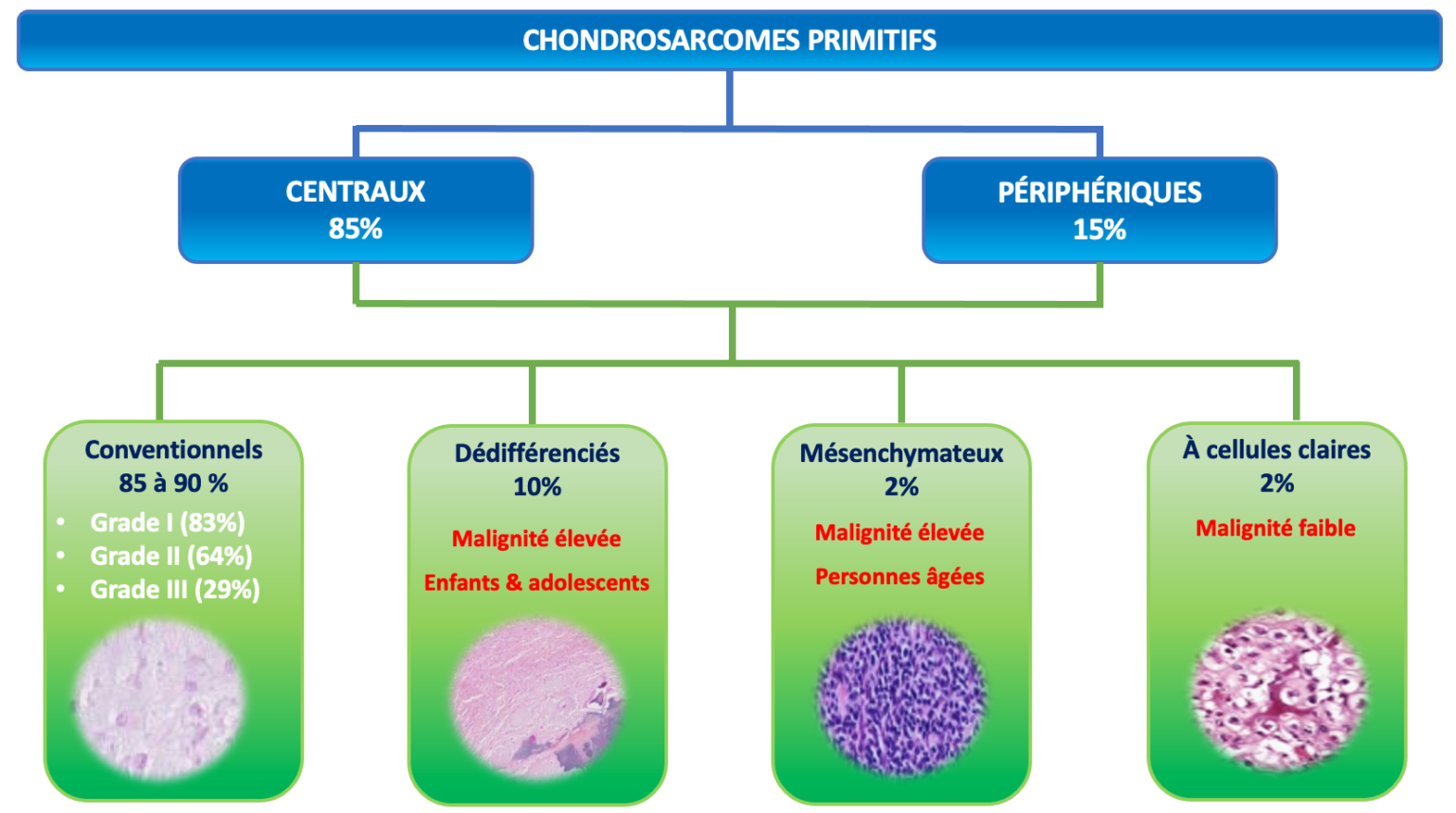 Les chondrosarcomes - Info Sarcomes